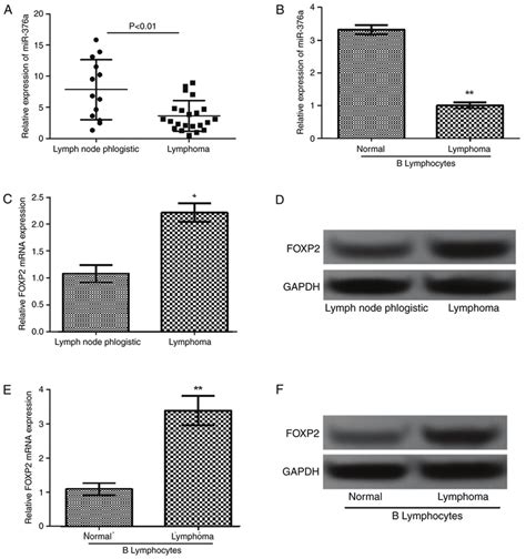 Expression Of Mir A In Lymphoma Tissue And Cells The Relative