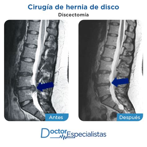 Ortopedistas Para Cirugia De Hernia Discal Doctor Especialistas