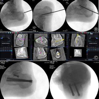A Typical Case A Preoperative Radiographic Images B Posterior