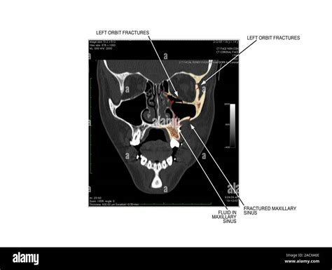 Fracturas De Cr Neo Facial Coronal Tomograf A Axial Computada Tac De
