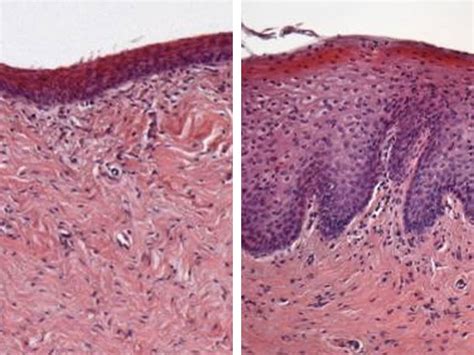 Modificaciones en la mucosa vaginal tras el tratamiento con láser