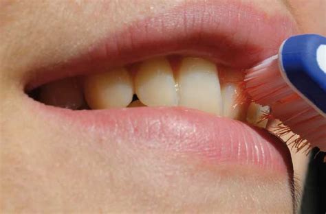 Qué es la gingivitis y cómo podemos curarla