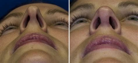 Asymmetric Nostrils Rhinoplasty In Seattle