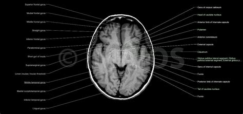 Cross Sectional Anatomy Of The Brain A Module Based On MRI Mri