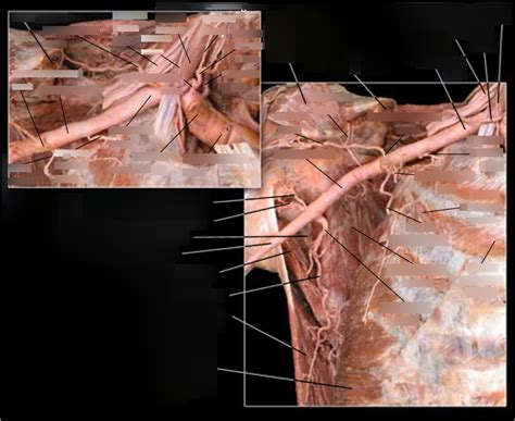 AXILLARY REGION SHOWING THE BRACHIAL PLEXUS AND THE BLOOD VESSELS