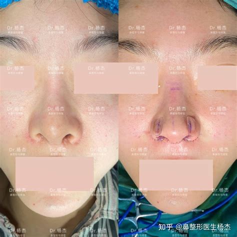耳软骨鼻修复鼻小柱缩短鼻槛修复重建鼻翼缘退缩矫正鼻翼外切修疤 知乎
