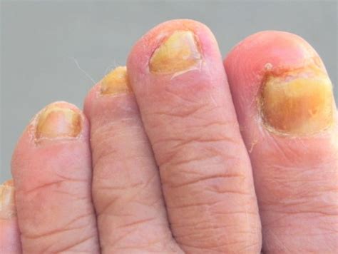 como eliminar las uñas amarillas y gruesas de los pies Me lo dijo Lola