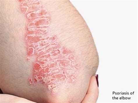 Psoriasis Elbow
