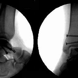 Preoperative Radiographs And Computed Tomographic Scans Showing