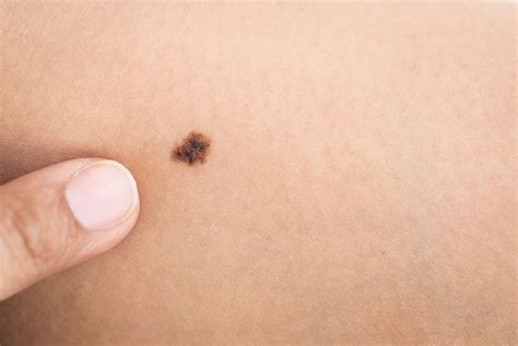 Here S How To Check If Your Mole Is Cancerous Health The Jakarta Post
