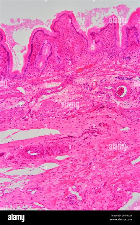 Gallbladder Wall Showing Columnar Epithelium With Mucosal Folds