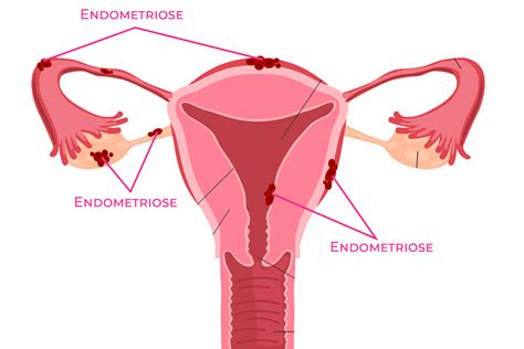 Endometriose Sintomas Causas E Tratamento