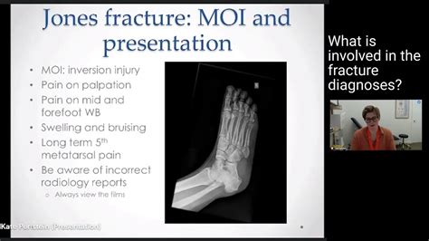 5th Metatarsal Fractures Treatment Diagnosis YouTube