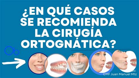 En qué casos se recomienda la Cirugía Ortognática YouTube