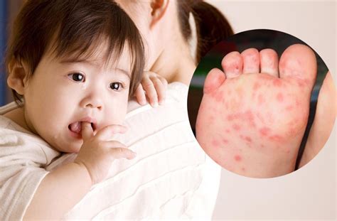 Bệnh tay chân miệng Nguyên nhân và dấu hiệu nhận biết