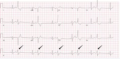 Ventricular Tachycardia And Premature Ventricular Contraction Catheter