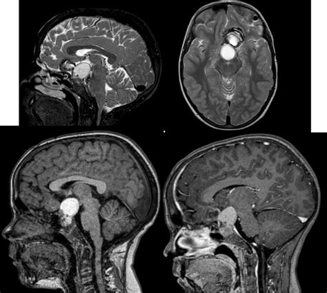 Craniopharyngioma T2 Weighted And Contrast Enhanced T1 Weighted Axial