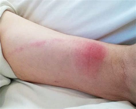 Viêm mô tế bào Nguyên nhân triệu chứng và cách điều trị