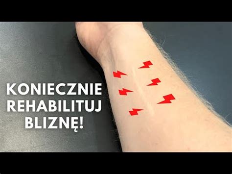 Mobilizacja Blizny Z Tego Filmu Dowiesz Si Dlaczego Twoja Blizna Musi