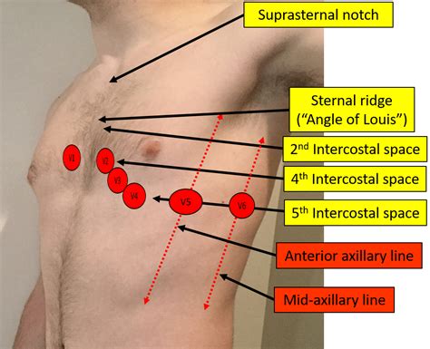 Lead Ekg Placement Diagram With Heart