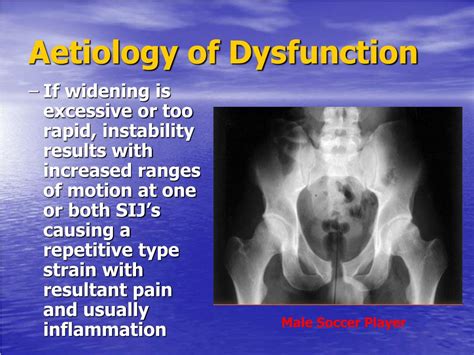 PPT SYMPHYSIS PUBIS DYSFUNCTION PowerPoint Presentation Free