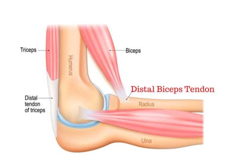 Distal Bicep Tendon Pain