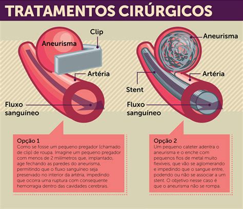 O que é aneurisma cerebral e como tratar Neurocirurgia e Tratamento