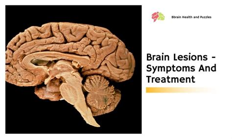 Lesions On The Brain Causes Symptoms Diagnosis And Treatment NBKomputer