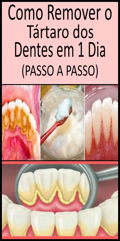 Como Remover O T Rtaro Dos Dentes Em Dia Passo A Passo Food
