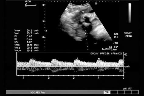 Latido cardíaco fetal gráfico semanal y métodos utilizados para