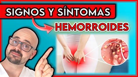 Hemorroides o Cáncer de Colon SIGNOS y SÍNTOMAS que indican
