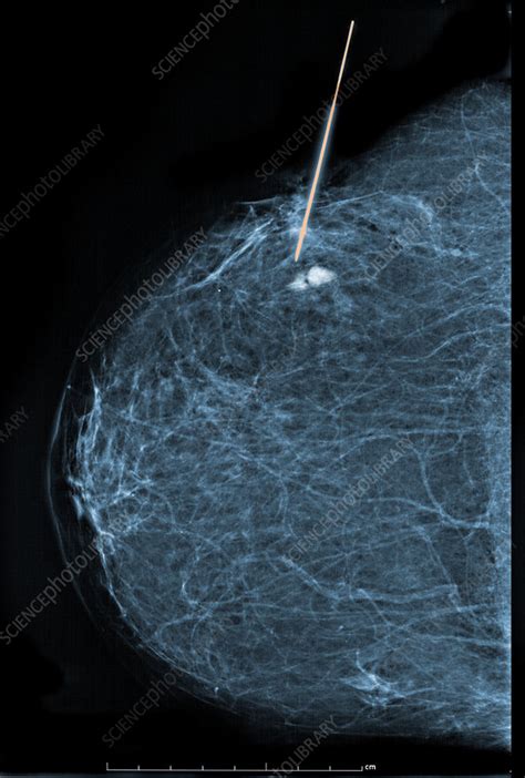Stereotactic Biopsy Of Breast Stock Image C Science Photo