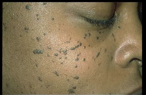 MSK Neoplastic Dermatopathology Gardner Flashcards Quizlet
