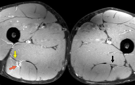 The Radiology Assistant Hamstring Injury