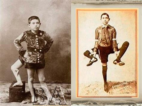 La increíble vida del hombre que nació con 3 piernas y el secreto de su