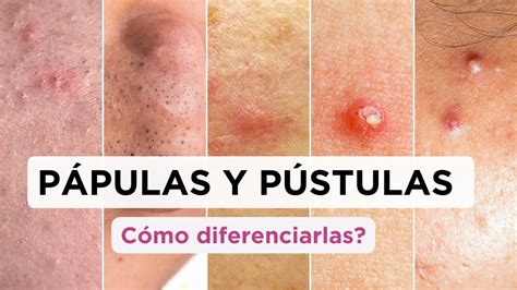 Pápulas y Pústulas Cómo diferenciarlas YouTube