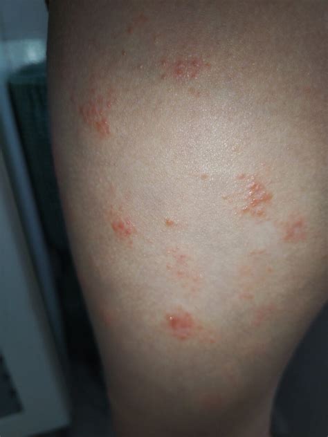 Dermatite Bambino Dermatologia Pediatrica DermaClub Forum