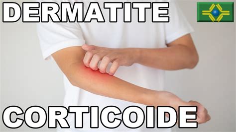 Dermatite A Pomada A Base De Corticoide Piorou A Dermatite Do Meu