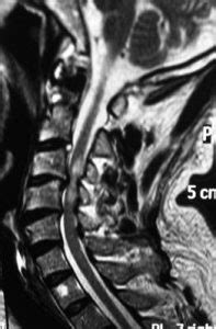Dor Na Coluna Cervical Ou Cervicalgia Dr Luciano Pellegrino