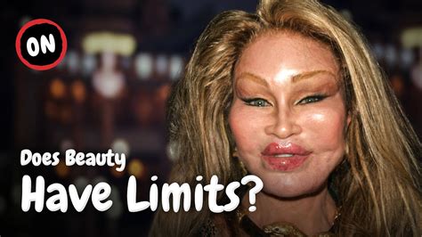 What Happens When You Inject Too Much Botox YouTube