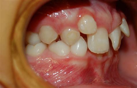 Crowding Of Teeth Is It Necessary To Correct How To Fix Crowding Of