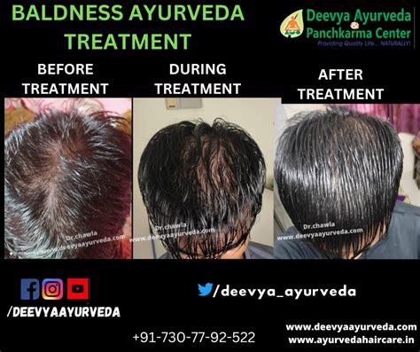 Seborrheic Dermatitis Scalp Hair Loss