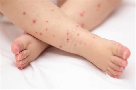 手足口病が全国で流行 子どもが感染した場合の症状は 大人にもうつる 注意点対処法を医師に聞くオトナンサーdメニューニュース