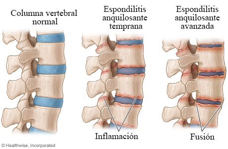 Espondilitis Anquilosante Cigna