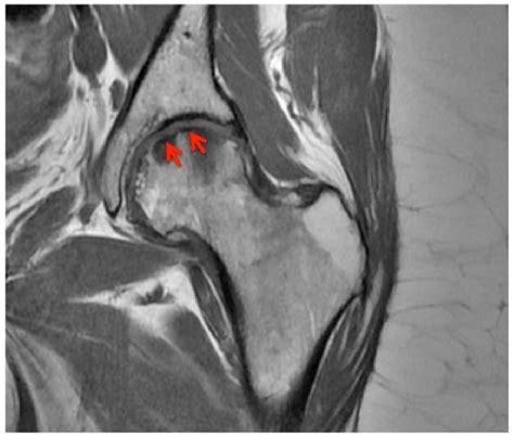 Figure 1 From Subchondral Insufficiency Fractures Of The Femoral Head