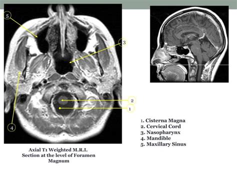 MRI Brain Basics And Radiological Anatomy Mri Mri Brain Radiology