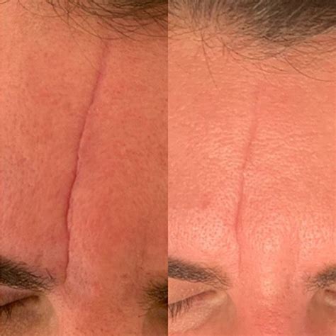 Traitement des cicatrices à Paris Skincare Agency