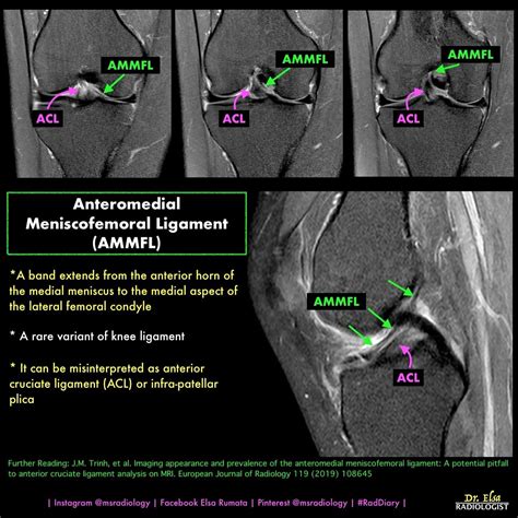 A Rare Variant Of Knee Ligament Which Extends From The Anterior Horn Of