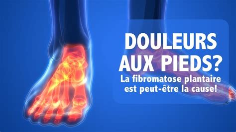 DOULEURS AUX PIEDS La fibromatose plantaire est peut être la cause