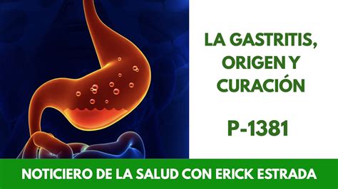 P La Gastritis Origen Y Curaci N Youtube